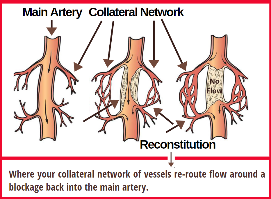 How To Build Your Own “Natural Bypass” – PAD: The Lived Experience